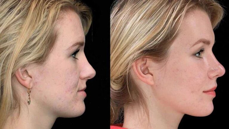 Mewing là gì? Cách tập mewing như thế nào cho đúng phương pháp? - Nha ...