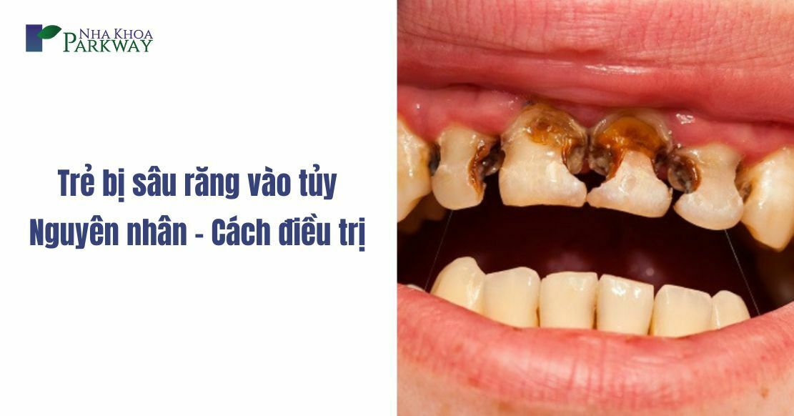 Trẻ bị sâu răng ăn vào tủy: Nguyên nhân và cách điều trị
