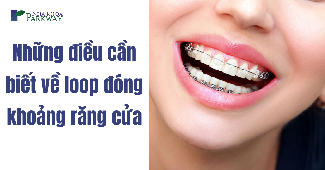 Loop đóng khoảng răng cửa là gì? Và những điều cần biết