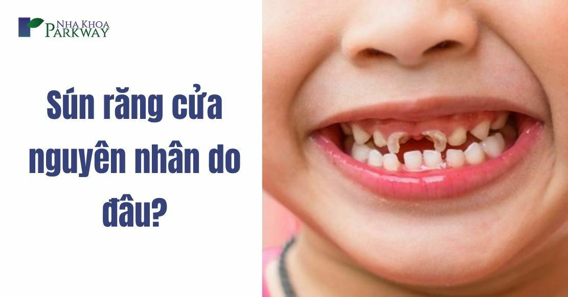 Cách chăm sóc hình ảnh sún răng để duy trì nụ cười tươi sáng