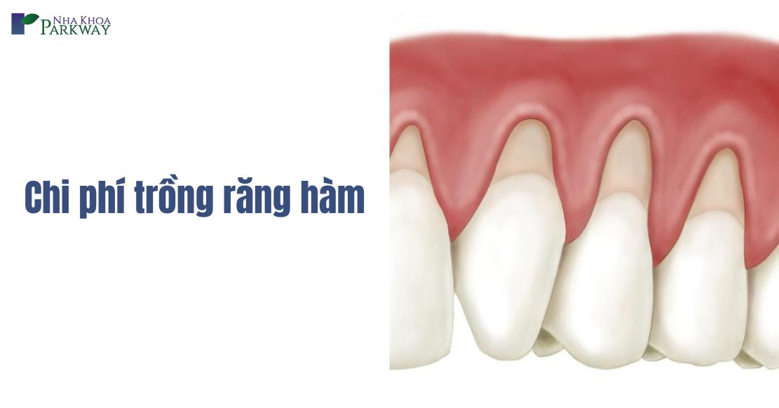 Trồng răng hàm giá bao nhiêu? Nên trồng răng hàm loại nào?