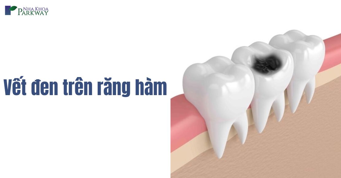 Vết đen trên răng hàm? Nguyên nhân, phương pháp điều trị