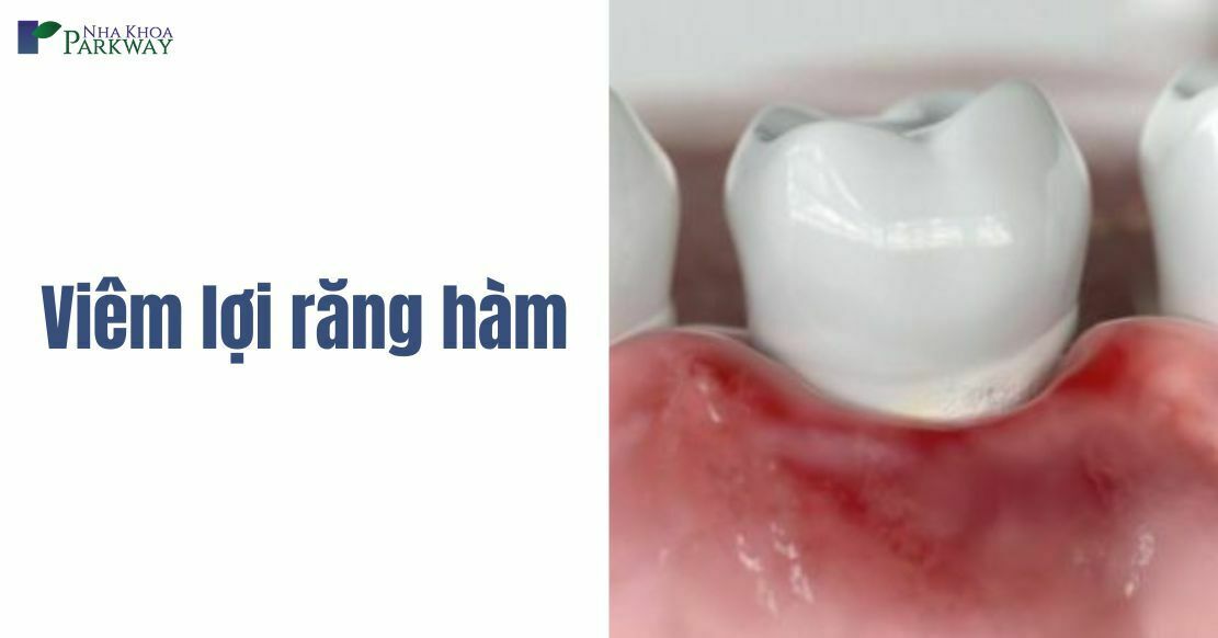 Viêm lợi răng hàm: Nguyên nhân, cách điều trị sưng chân răng