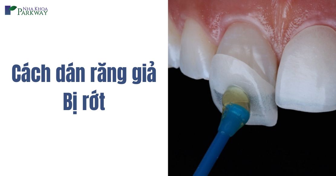 Cách dán răng giả bị rớt tại nha khoa