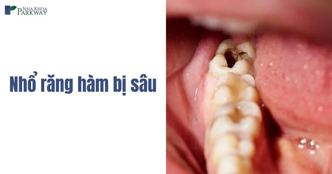 Nhổ răng hàm bị sâu - Khi nào nên nhổ? Phương pháp điều trị? - Nha Khoa ...