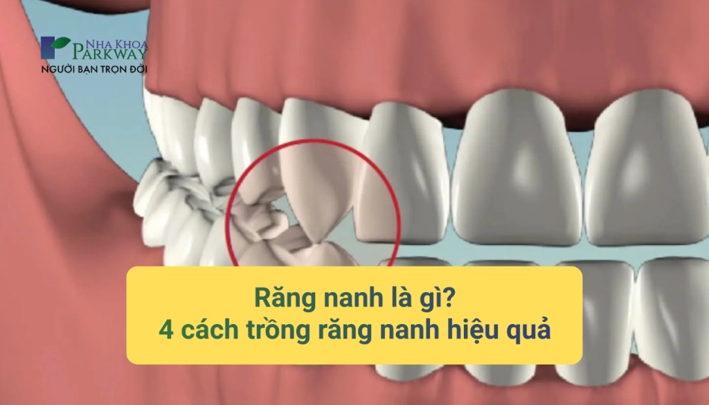 Răng nanh là gì? 4 cách trồng răng nanh hiệu quả