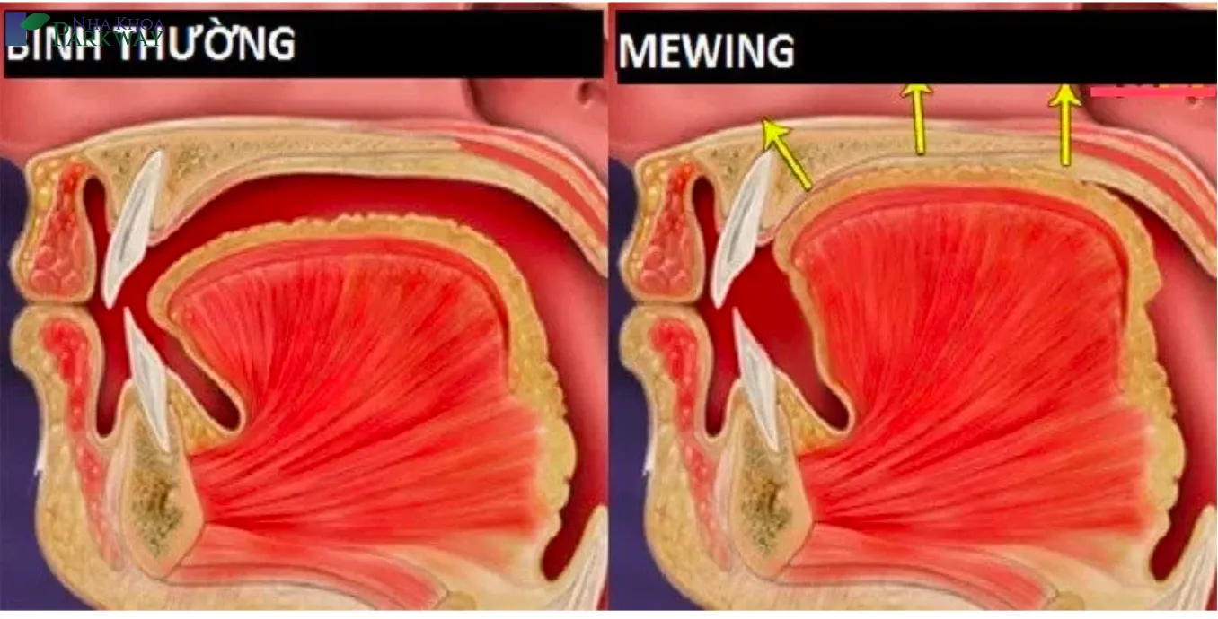 Mewing là gì? Tập Mewing đúng cách cho người mới bắt đầu