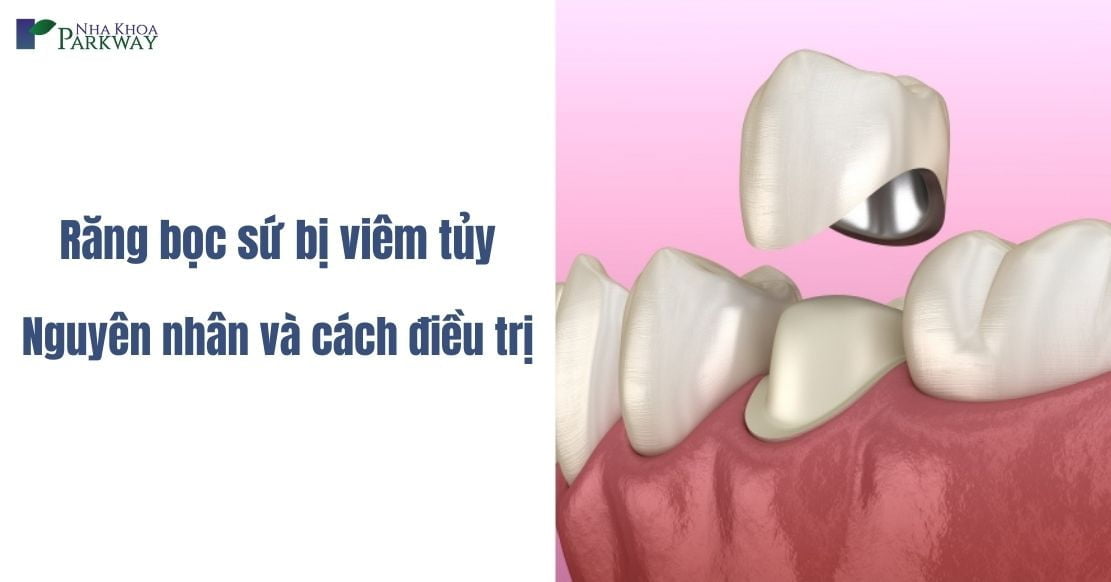 Răng bọc sứ bị viêm tủy: Nguyên nhân, biến chứng và điều trị