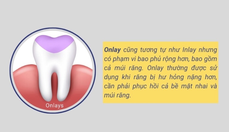 Inlay, Onlay là gì? Ưu nhược điểm của trám răng Inlay/Onlay