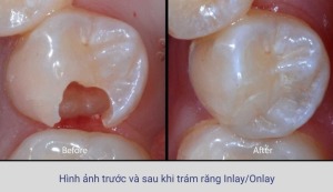 Inlay, Onlay là gì? Ưu nhược điểm của trám răng Inlay/Onlay