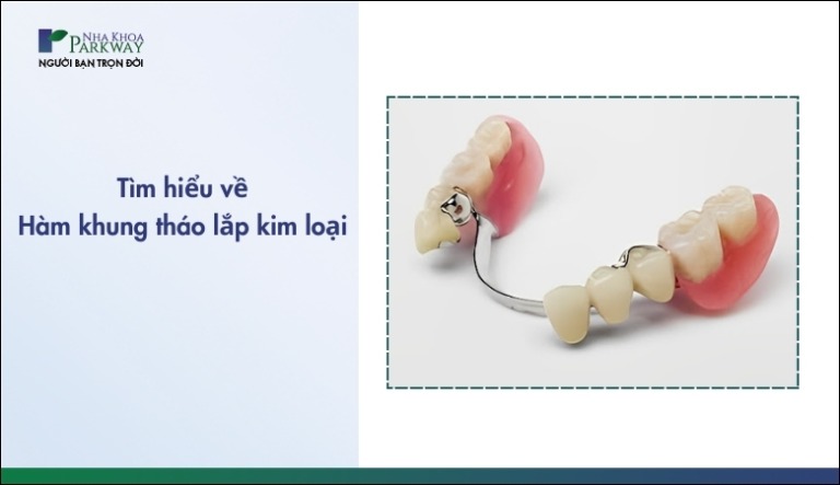 Những điều cần biết về hàm khung tháo lắp kim loại