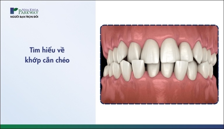Khớp cắn chéo là gì? Nguyên nhân, dấu hiệu, cách khắc phục