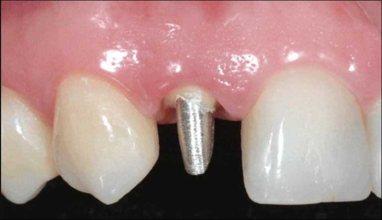 Cắm chốt răng là gì? Khi nào phải cắm chốt răng?