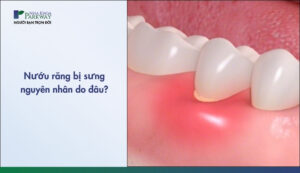 7 cách khắc phục nướu răng bị sưng hiệu quả, an toàn